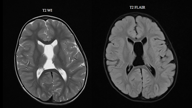 Ultimate Radiology : Arachnoid cyst of Septum Pellucidum