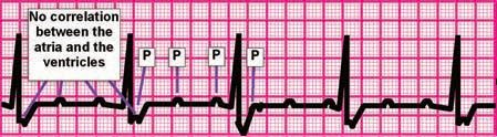 Third-Degree AV Block (Complete Heart Block) ~ Nursing