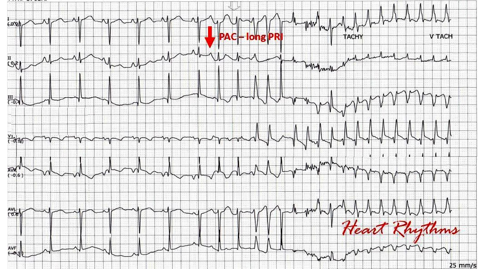 ECG Rhythms: SVT (probably AVNRT) with spontaneous normalization