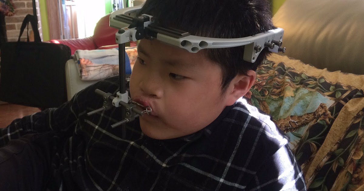 Henry: Midface Distraction Osteogenesis (2nd Phase)