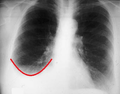 Read. Pray. Fellowship.: Meniscus Sign & Fluid in Abdomen