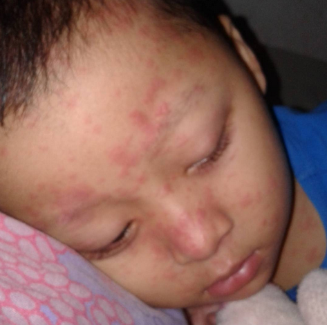 Cara Mengenali Dan Mengatasi Penyakit Campak Pada Anak - ibubayicare