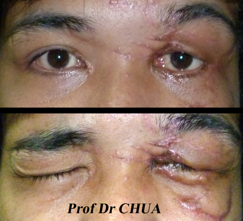 Eyelid Surgery by Prof Dr CN CHUA 蔡鐘能: A Patient with Problem Closing ...
