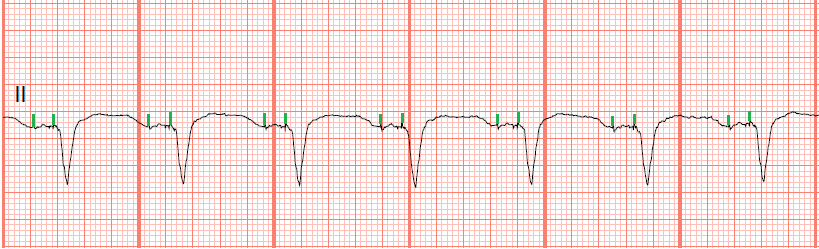 Basic EKG Rhythm Test 45