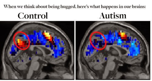 The Therapeutic Resources Blog: Seeing How The Brain Responds To Hugs Could Lead To Better ...