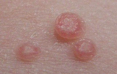 Tips Untuk Sehat dan Cantik: Jenis jerawat dan contohnya