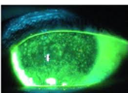 Contact Lens Solutions: Why your doctor never recommends generics ...