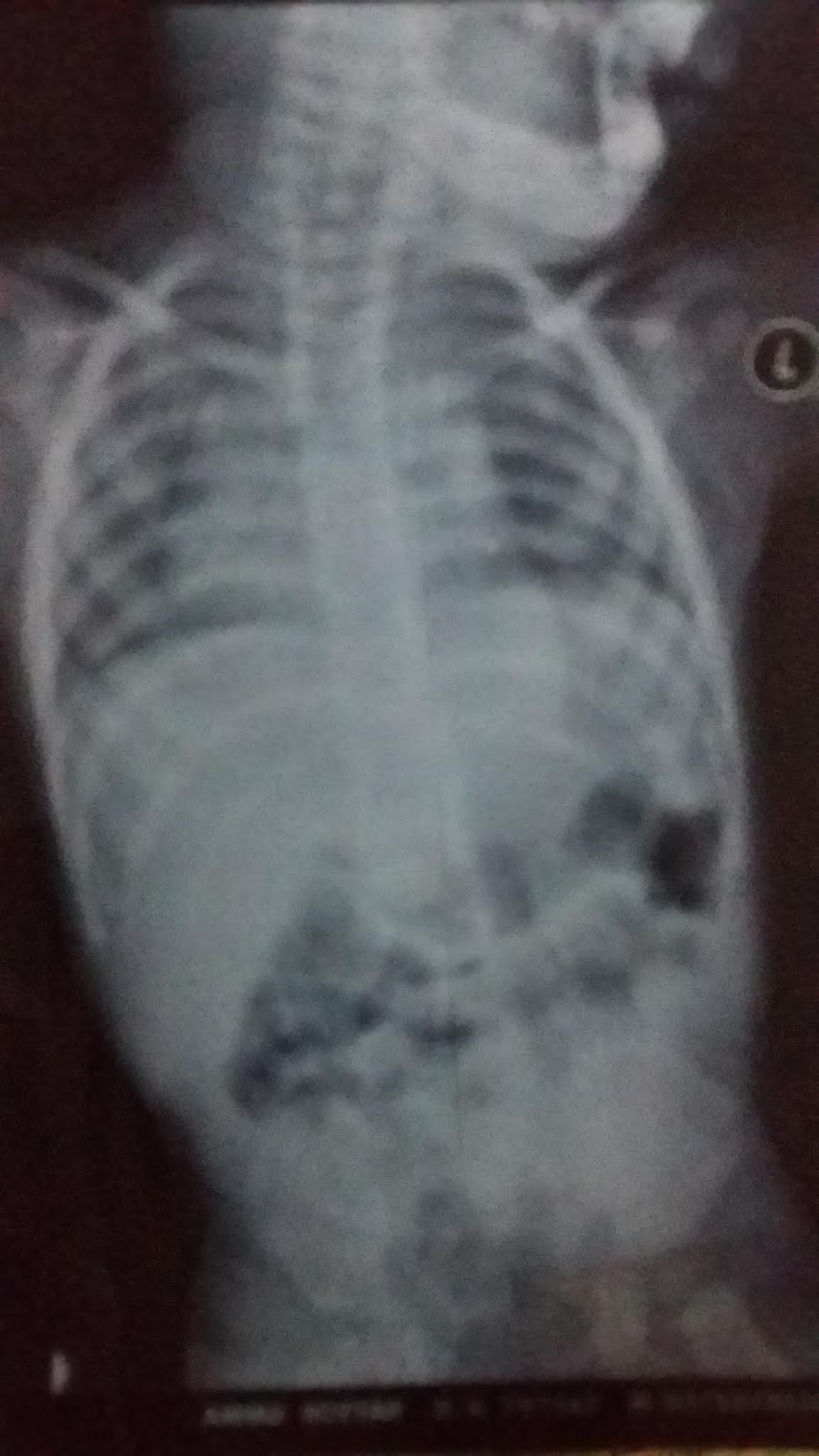 Contoh Hasil Ronsen Diagnosis TB Kelenjar pada Anak