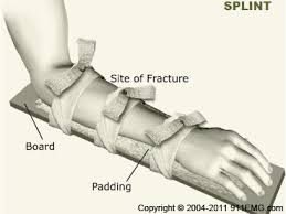 OIG's Blog: First Aid management of closed fracture (continued).
