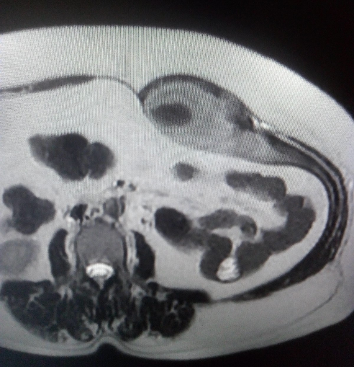 Abdominal wall mass –MRI Approach - Sumer's Radiology Blog