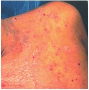 DERMATOLOGIA: UNIDAD II