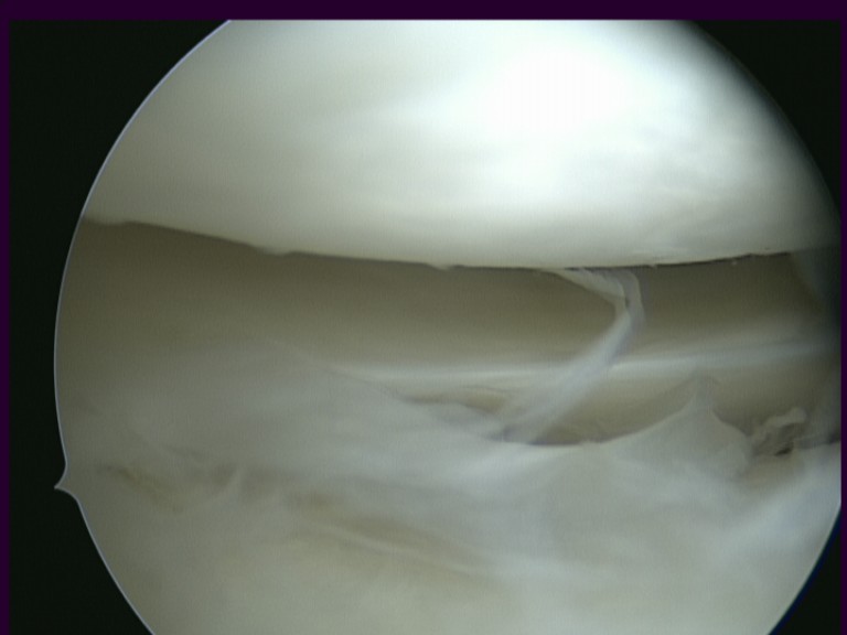 Right Knee Arthroscopy Surgery