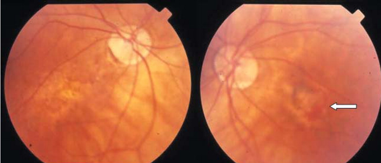 Angry Angry Guru: The OMENS => Treacher Collins Franceschetti Syndrome