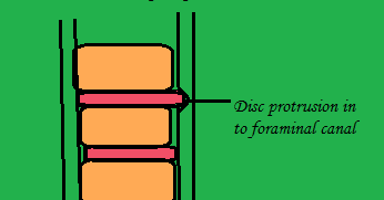 prolapsed intervertebral disc|pivd definition|pivd stages|pivd types ...