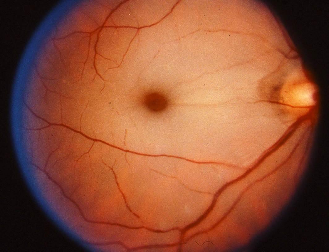 PLAB king: Flame shaped hemorrhages (372/1700)