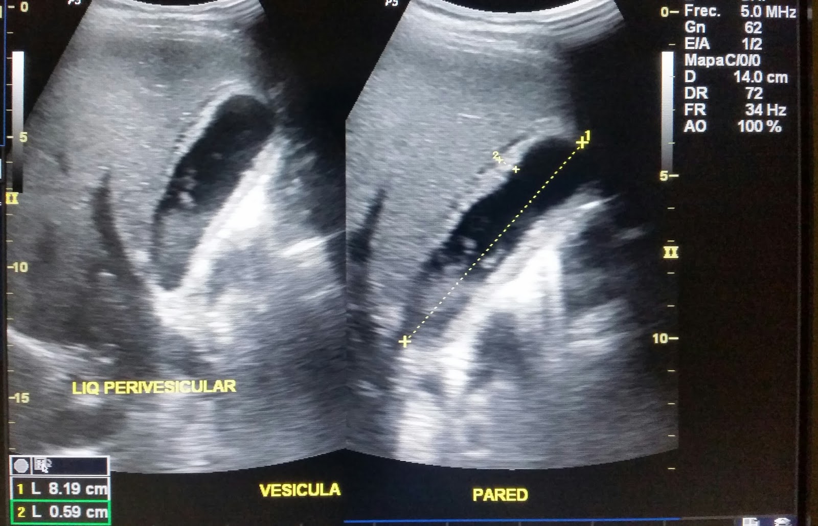 Patología biliar en embarazo