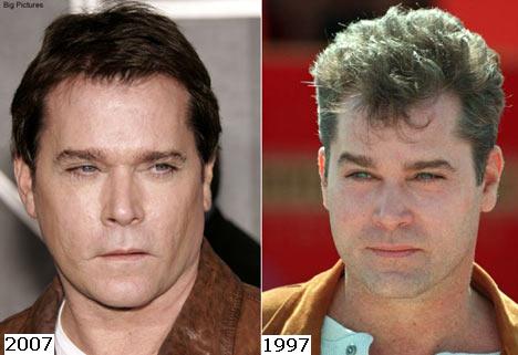 Ray Liotta Plastic Surgery