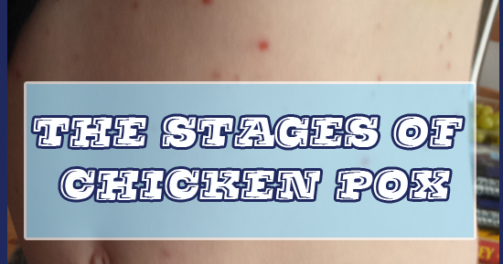 What are the stages of Chickenpox - Lifestyle & DIY blogger with a ...