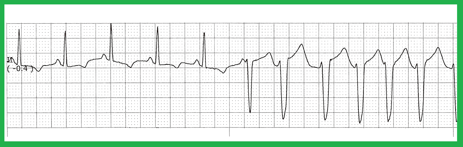 Ventricular rhythm Quiz 294