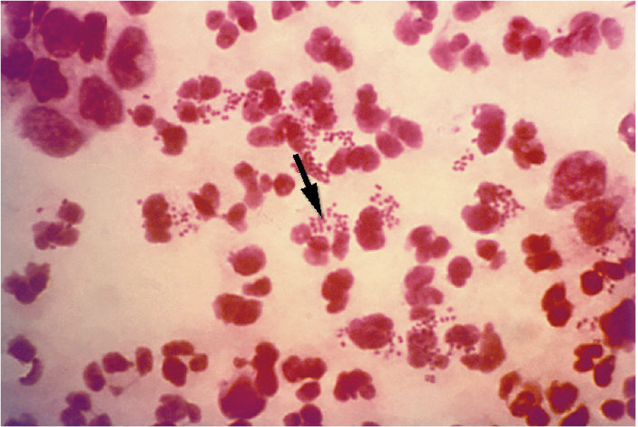 Gonorrhea | cause ~ infectious diseases