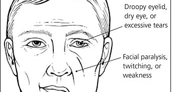 KENALI APA ITU BELL'S PALSY