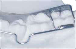 DISEÑAR APARATOLOGIA: PLACA DE HAWLEY ARCO SOLDADO A ADAMS