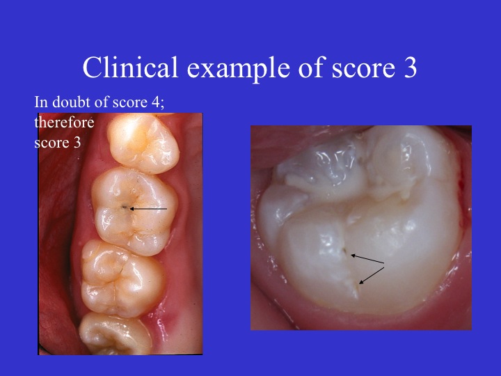 ICDAS-JHCDA: ICDASのHPが更新されました