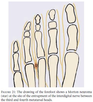 Fisioinforma: As 5 principais neuropatias nos membros inferiores ...