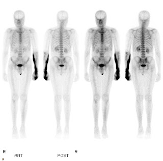 NuCleaR MuNkeE: Arterial Injection