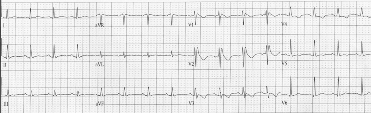 Dr. Smith's ECG Blog: Right Bundle Branch Block with New Anterior ST ...