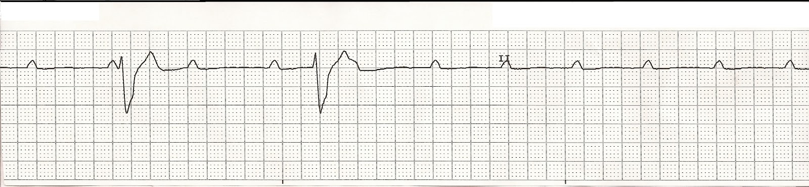 EKG Rhythm Strip Quiz 5