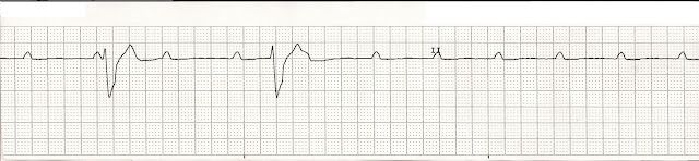 Float Nurse: EKG Rhythm Strips 35