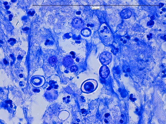 Fun With Microbiology (What's Buggin' You?): Blastomyces dermatitidis