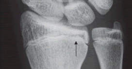 The Quest for Height: Grow Taller | Increase Height | Bone Size: Growth ...