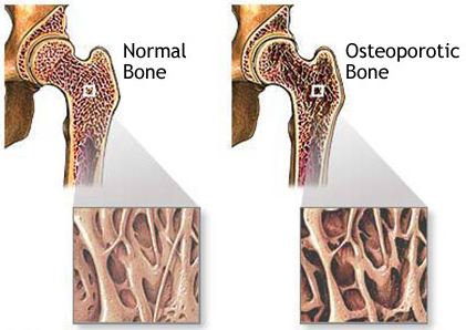 osteopenia vs osteoporosis