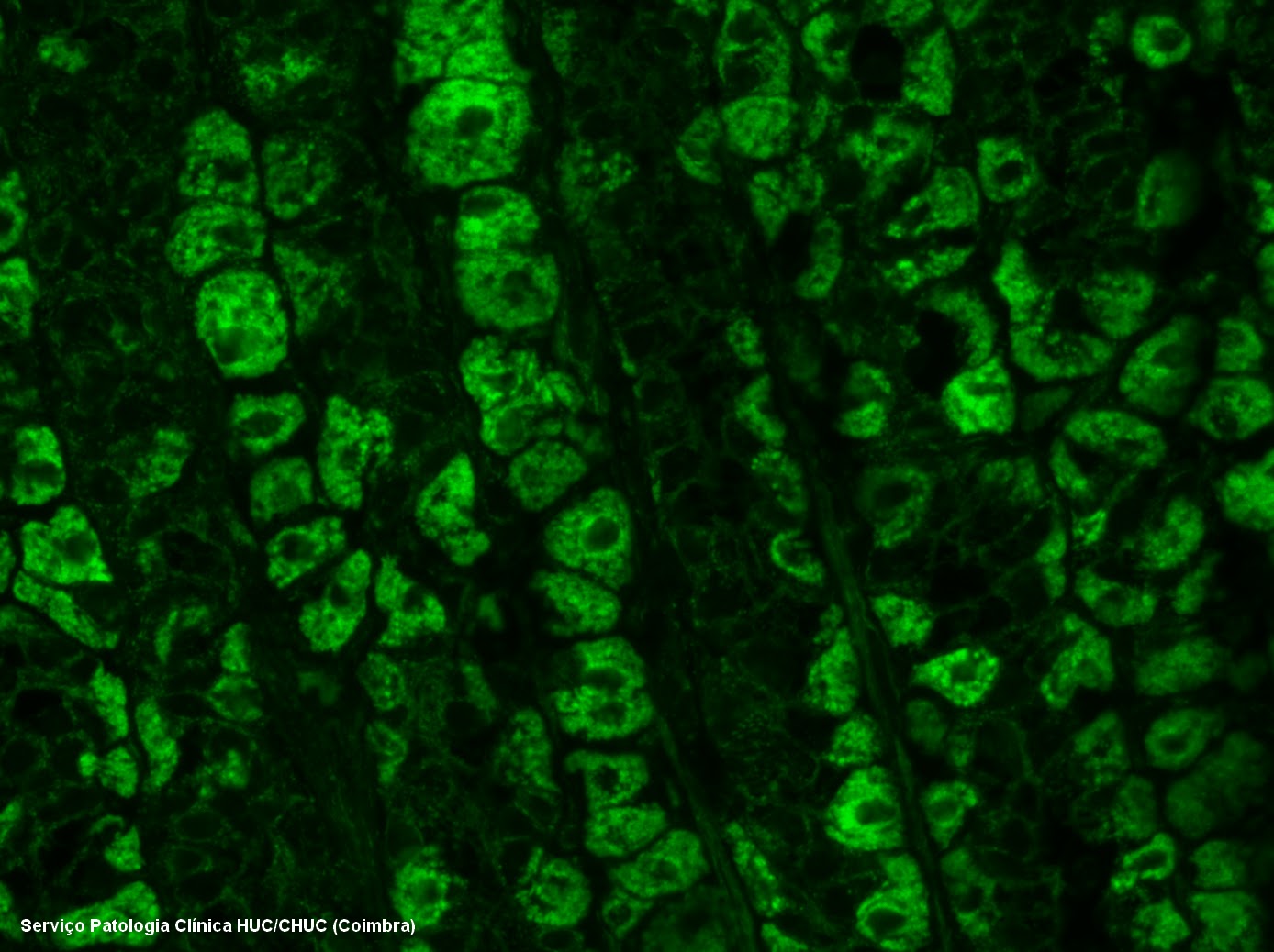 Anticorpos anti - LKM1