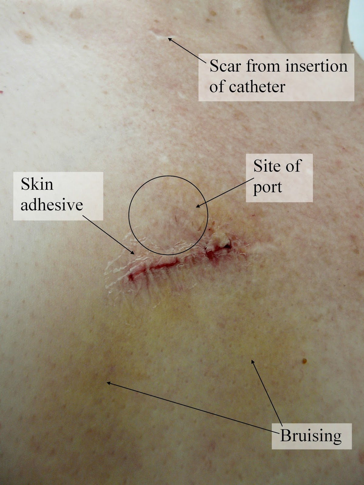 Shoshiplatypus: My Cancer Diary