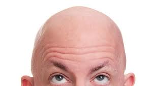 Homens carecas têm maior risco de problemas cardíacos