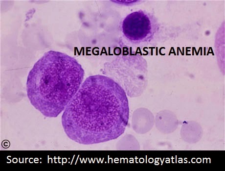 Lab Atlas: Megaloblastic Anemia