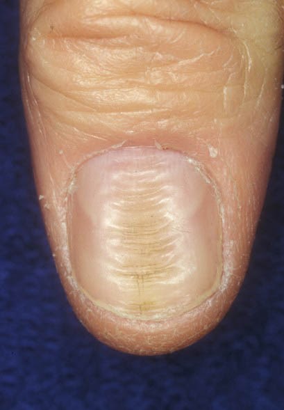 Nailing It: Habit Tic...Why Not To Pick Your Nails.