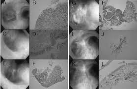 Medical Treatment Pictures-for Better Understanding: Bronchoscopy ...