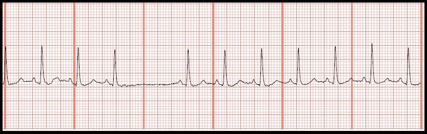 Characteristics of Sinus Rhythms