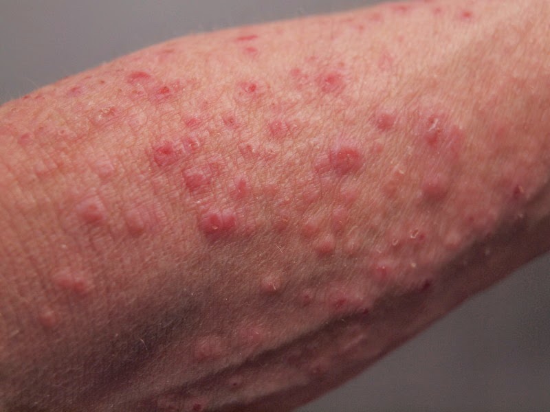 Atopisch eczeem behandelen met haakwormen: Slecht, slechter, slechtst