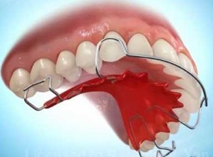 KLINIK PERGIGIAN SYARIFAH: Jenis -Jenis Retainer