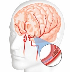 MENJAGA KESEHATAN UNTUK MENCEGAH SAKIT: ADA BERAPA MACAM STROKE?