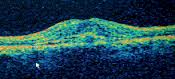 DEGENERACION MACULAR : OCT para la DMAE humeda