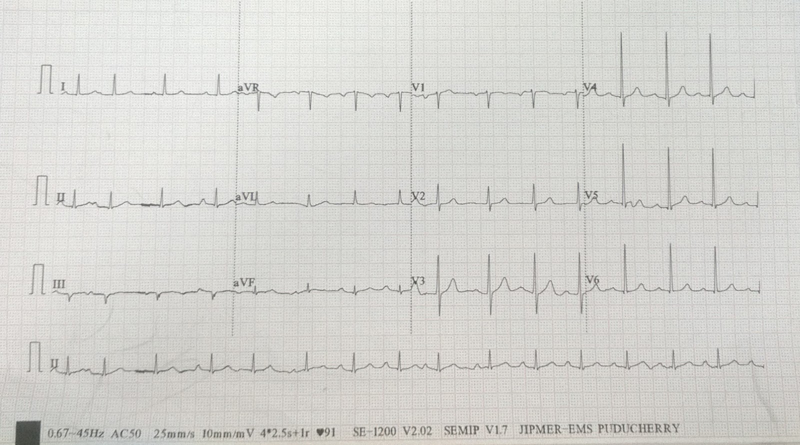 Cardiology window: Inferior wall myocardial infarction presenting as ...