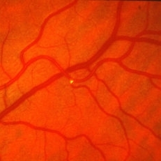 Cholesterol and The Eye - Eyedolatry
