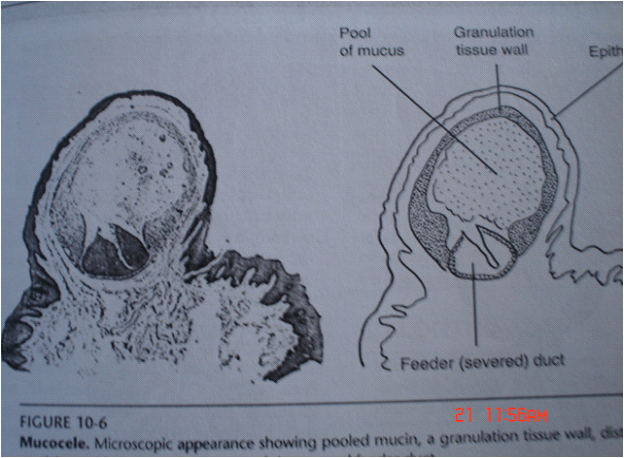 Dentistry and Medicine: Notes on Mucocele and Mucous Retention cyst ...