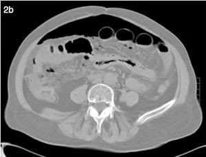 Tecnicos Radiologos: Signo Radiológico de Rigler, o de 'Doble pared' en ...